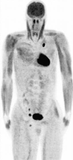 PET/CT with F-18FDG Prep - Cancer Care Specialists of IL